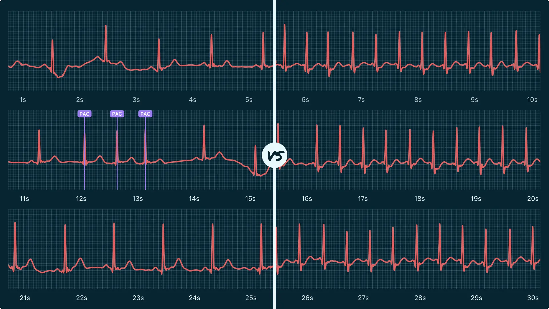 Ectopic Atrial Rhythm Vs. Atrial Fibrillation on Your Watch ECG | Qaly